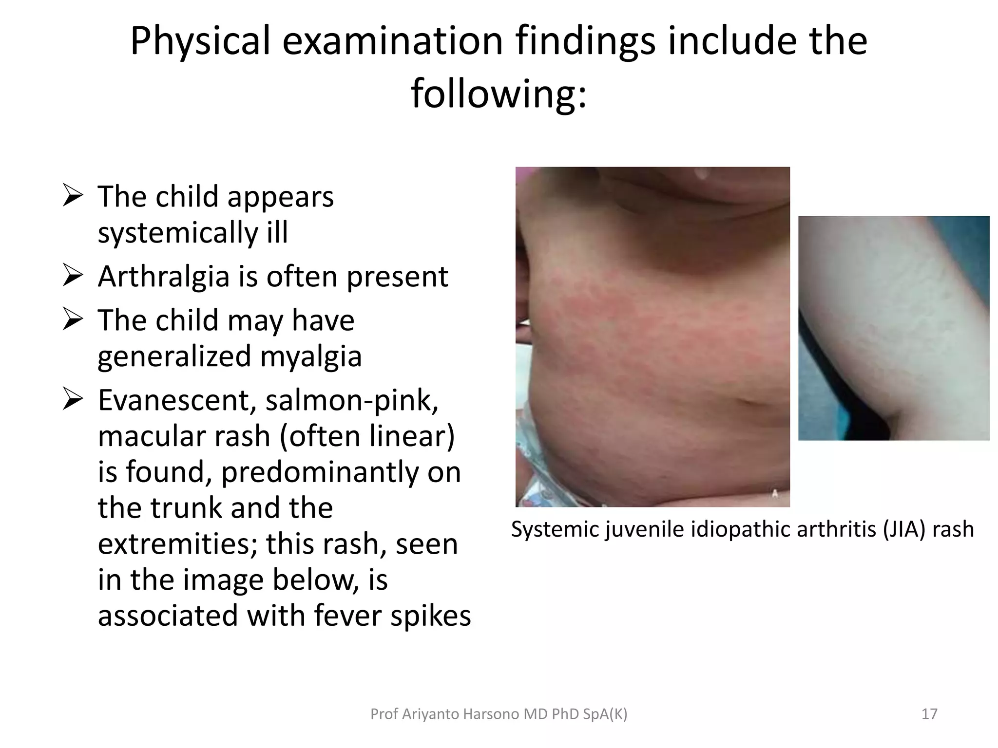 Juvenile idiopathic arthritis | PPTX