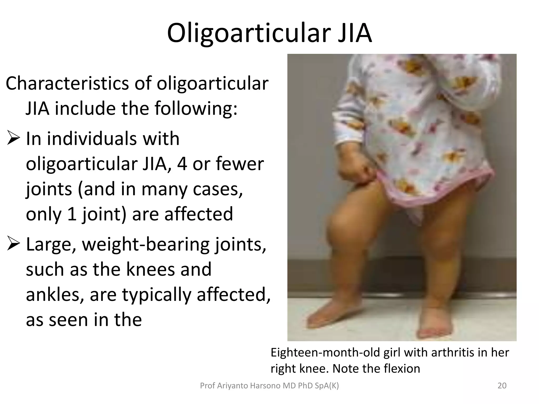 Juvenile idiopathic arthritis | PPTX