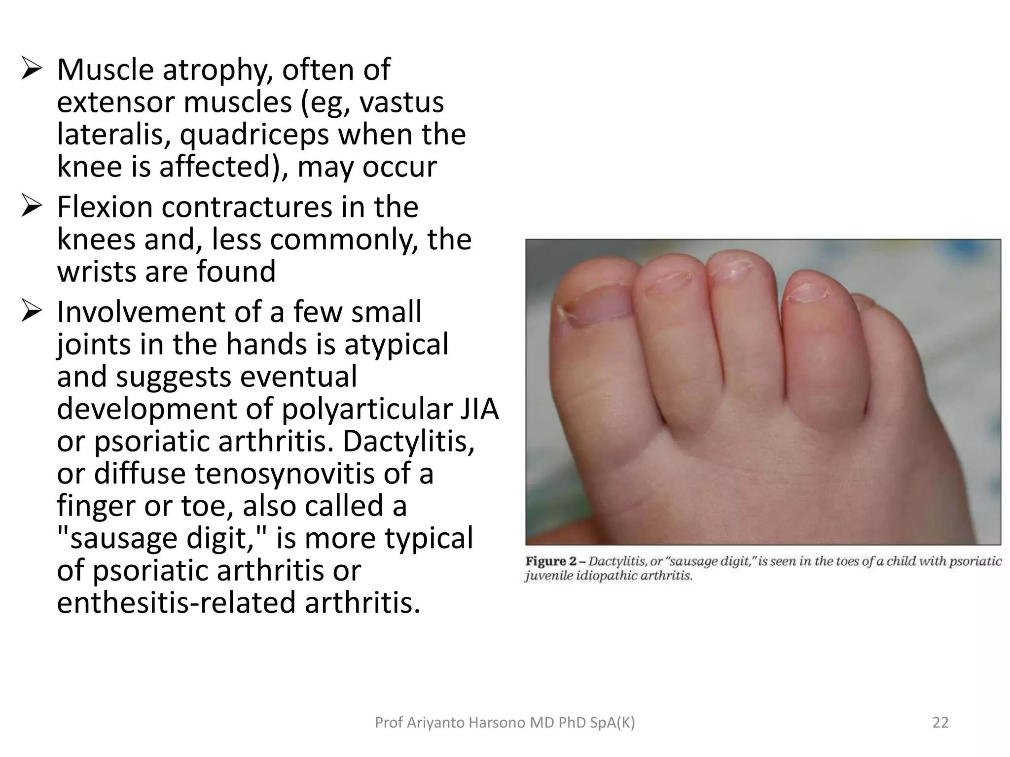 Juvenile idiopathic arthritis | PPTX