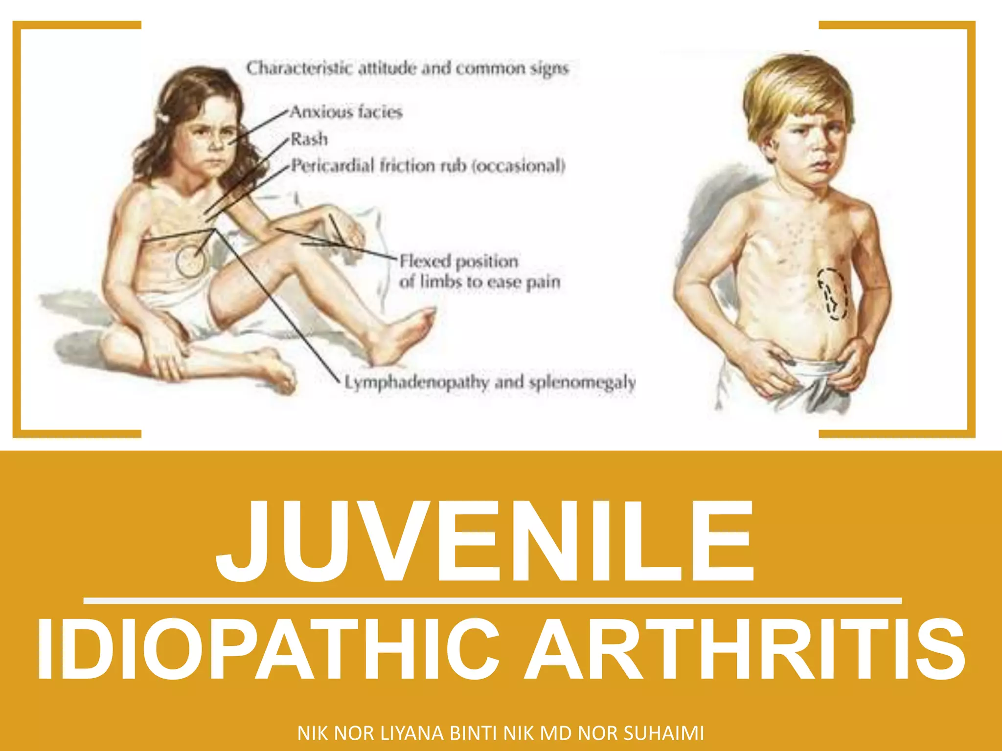 Juvenile idiopathic arthritis (JIA) | PPTX