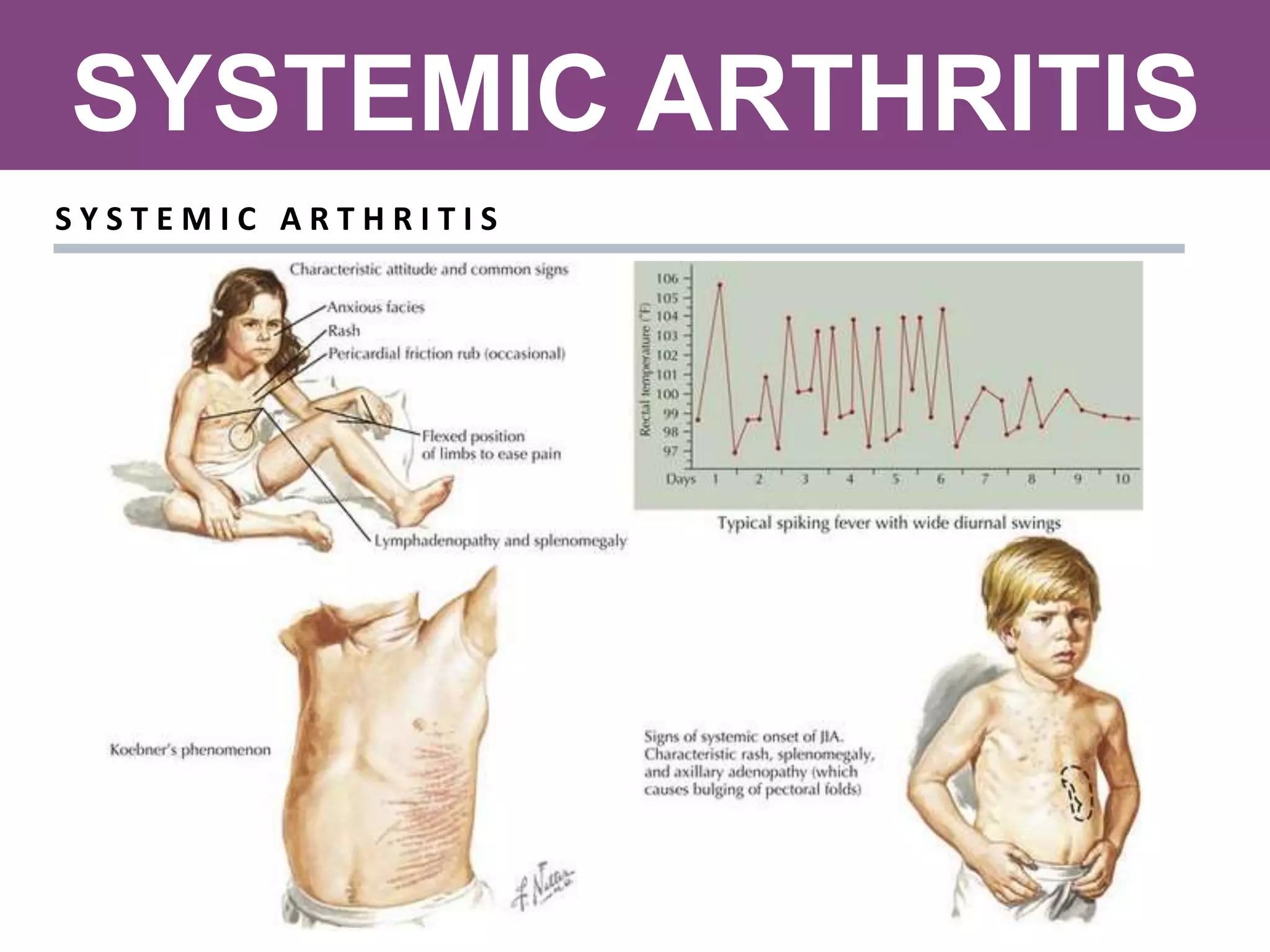 Juvenile Idiopathic Arthritis Jia Pptx