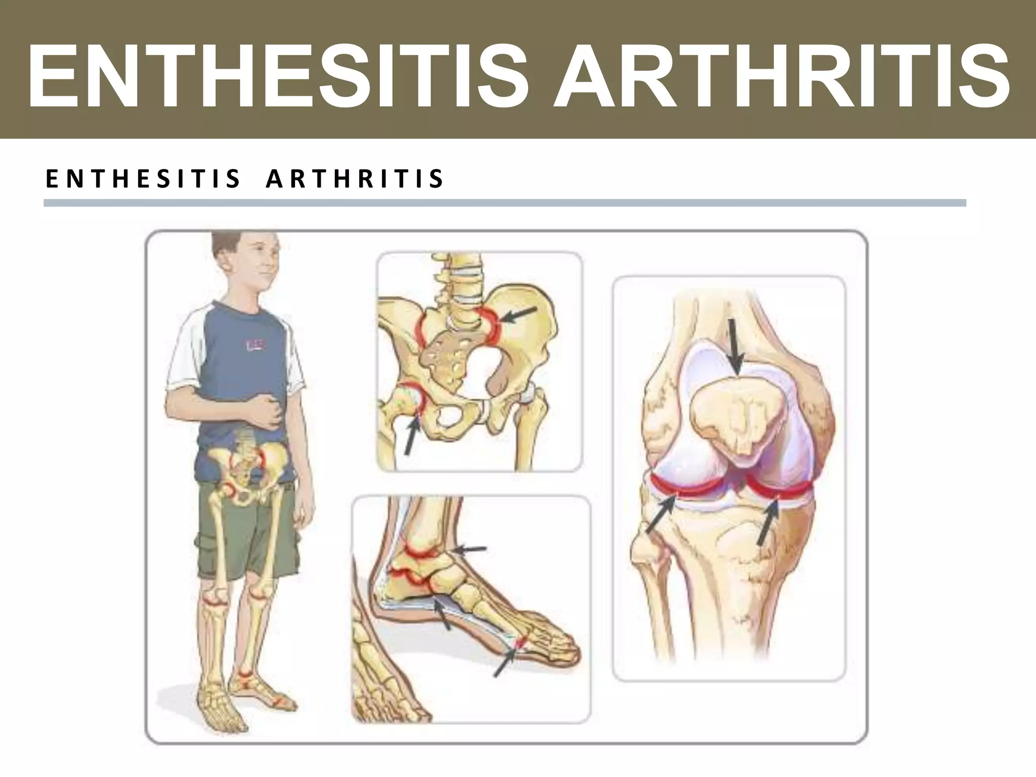 Juvenile idiopathic arthritis (JIA) | PPTX