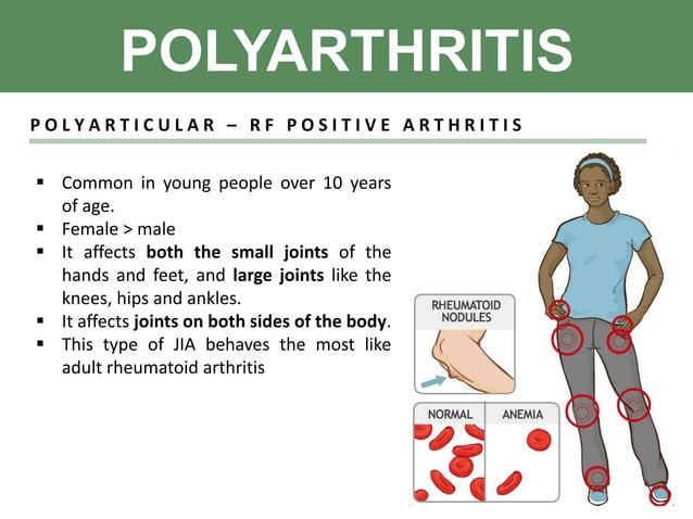 Juvenile idiopathic arthritis (JIA) | PPTX | Bone and Joint Conditions ...