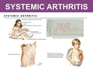 Juvenile idiopathic arthritis (JIA) | PPTX