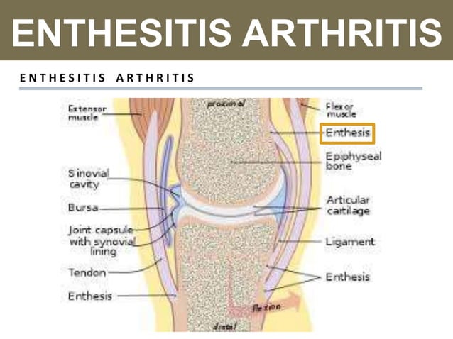 Juvenile idiopathic arthritis (JIA) | PPTX | Bone and Joint Conditions ...