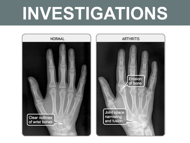 Juvenile idiopathic arthritis (JIA) | PPTX | Bone and Joint Conditions ...