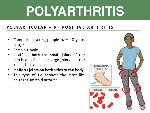 Juvenile Idiopathic Arthritis Jia