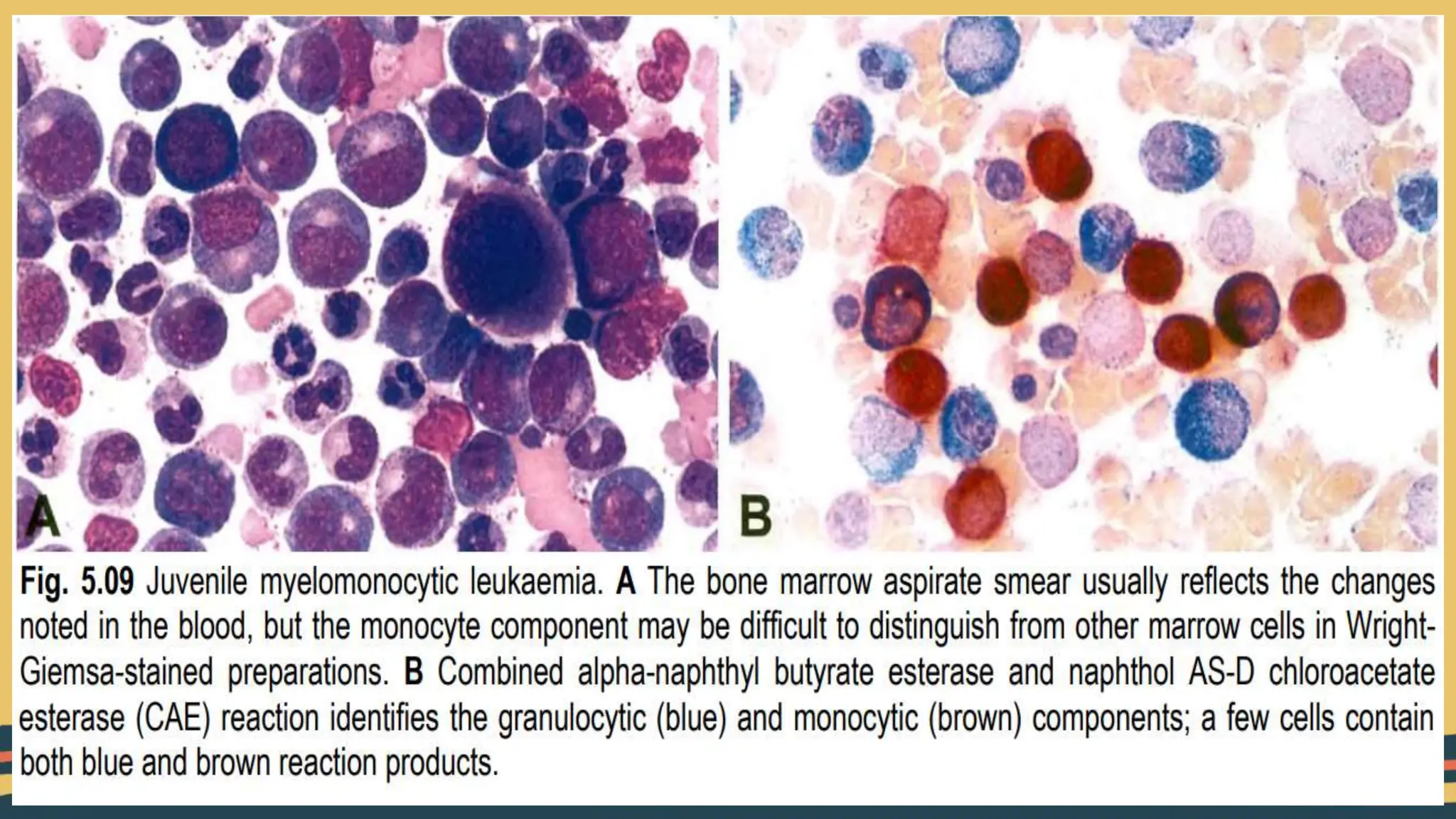Juvenile Myelomonocytic Leukemia (JMML) | PPTX