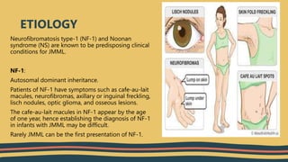 Juvenile Myelomonocytic Leukemia (JMML) | PPTX