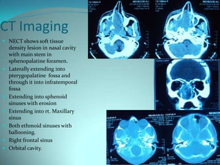 Juvenile nasal angiofibroma | PPTX