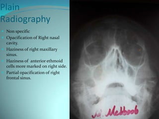 Juvenile Nasopharyngeal Angiofibroma Radiology