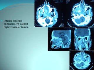 Juvenile Nasopharyngeal Angiofibroma Radiology