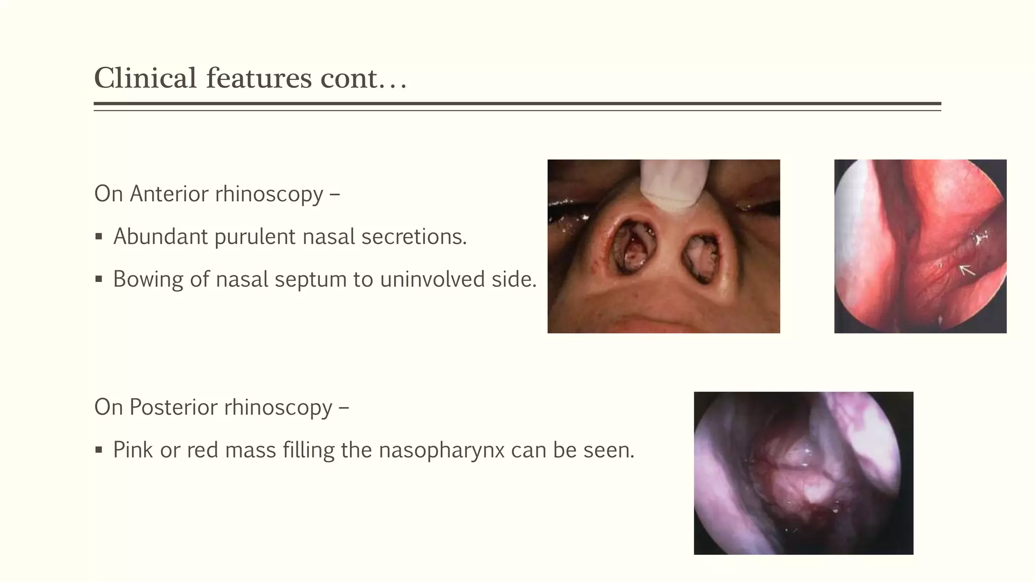Juvenile nasopharyngeal angiofibroma | PPTX