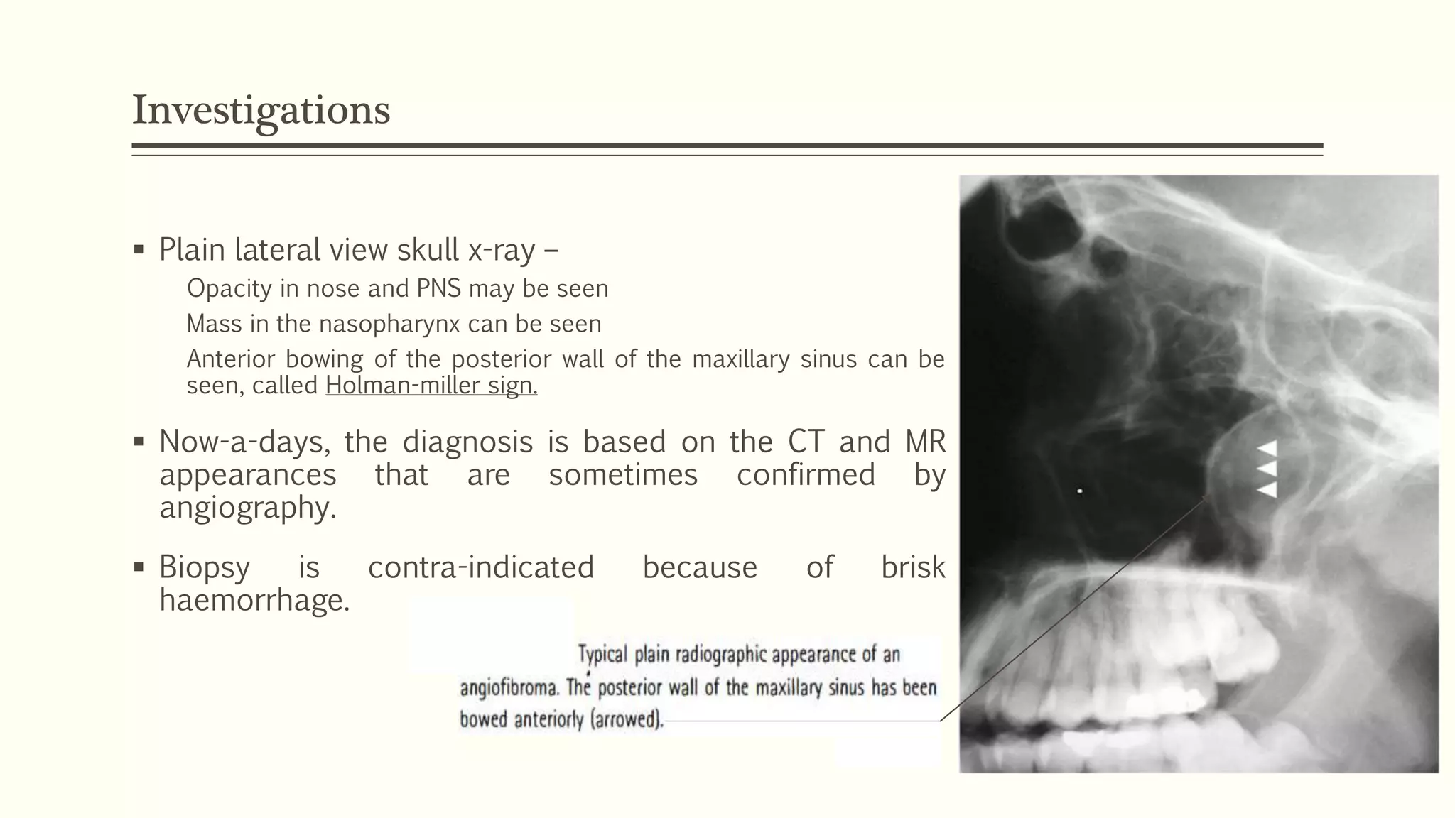 Juvenile nasopharyngeal angiofibroma | PPTX
