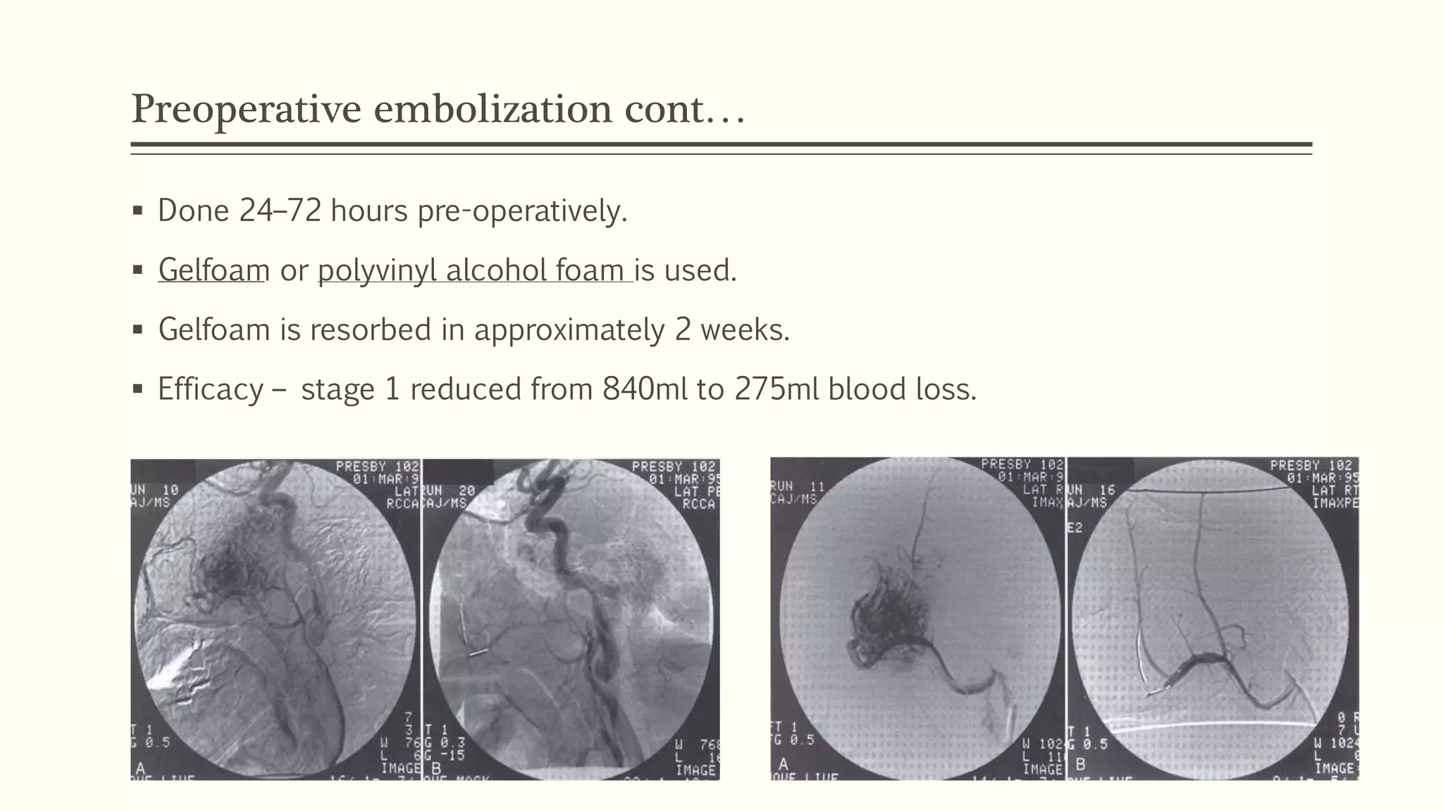 Juvenile nasopharyngeal angiofibroma | PPTX