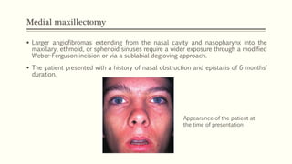 Juvenile nasopharyngeal angiofibroma | PPTX