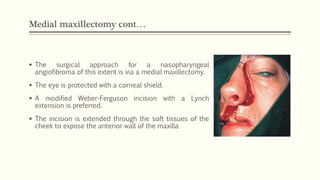 Juvenile nasopharyngeal angiofibroma | PPTX