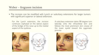 Juvenile nasopharyngeal angiofibroma | PPT