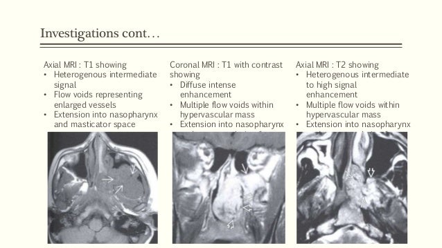 Juvenile nasopharyngeal angiofibroma