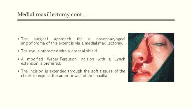Juvenile nasopharyngeal angiofibroma