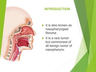 Nasopharyngeal Angiofibroma Ppt