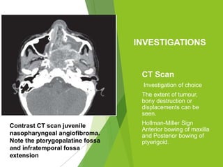 Juvenile Nasopharyngeal Angiofibroma Radiology
