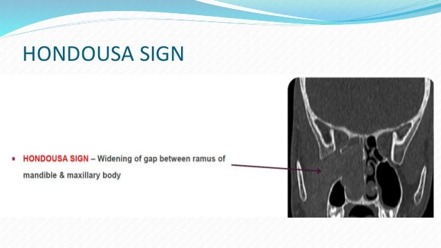 Juvenile nasopharyngeal angiofibroma