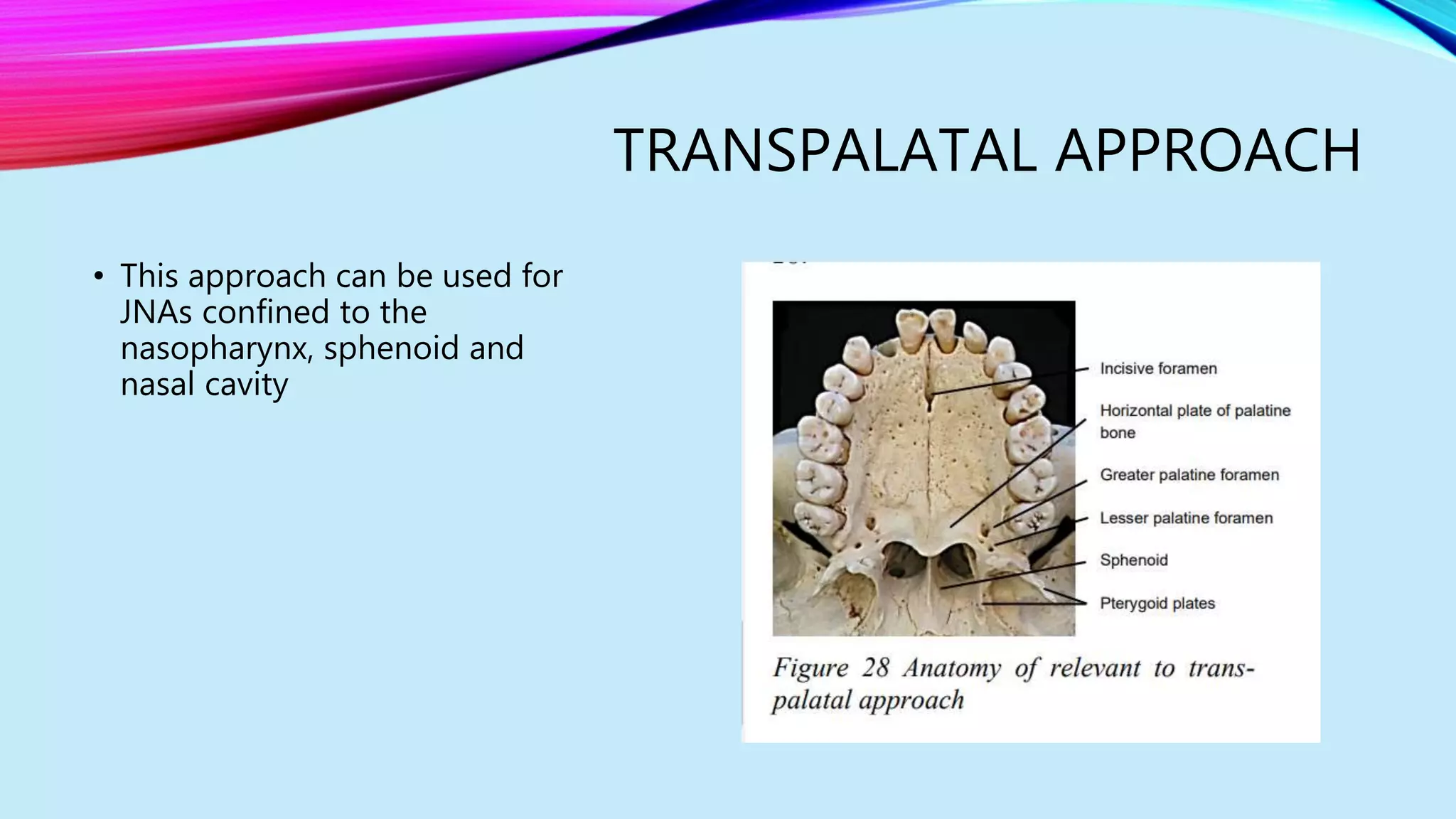 Juvenile nasopharyngeal angiofibroma.pptx