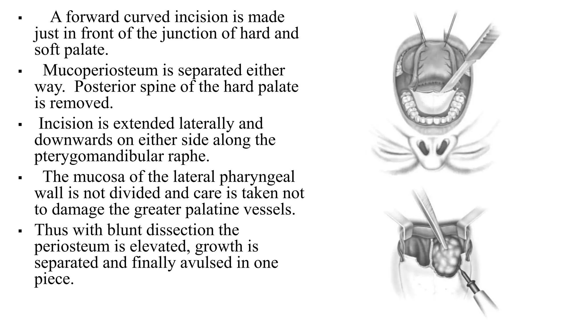 juvenile nasopharyngeal angiofibroma.pptx