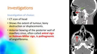 Juvenile Nasopharyngeal Angiofibroma.pptx
