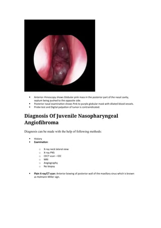 Juvenile nasopharyngeal angiofibroma.docx