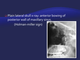 Juvenile nasopharyngeal angiofibroma 1.pptx