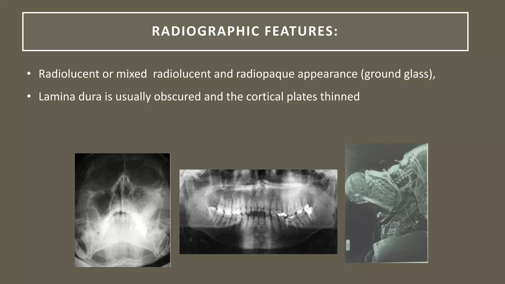 Juvenile Ossifying Fibroma | PPTX