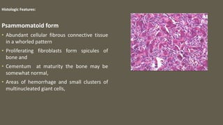 Juvenile Ossifying Fibroma | PPTX