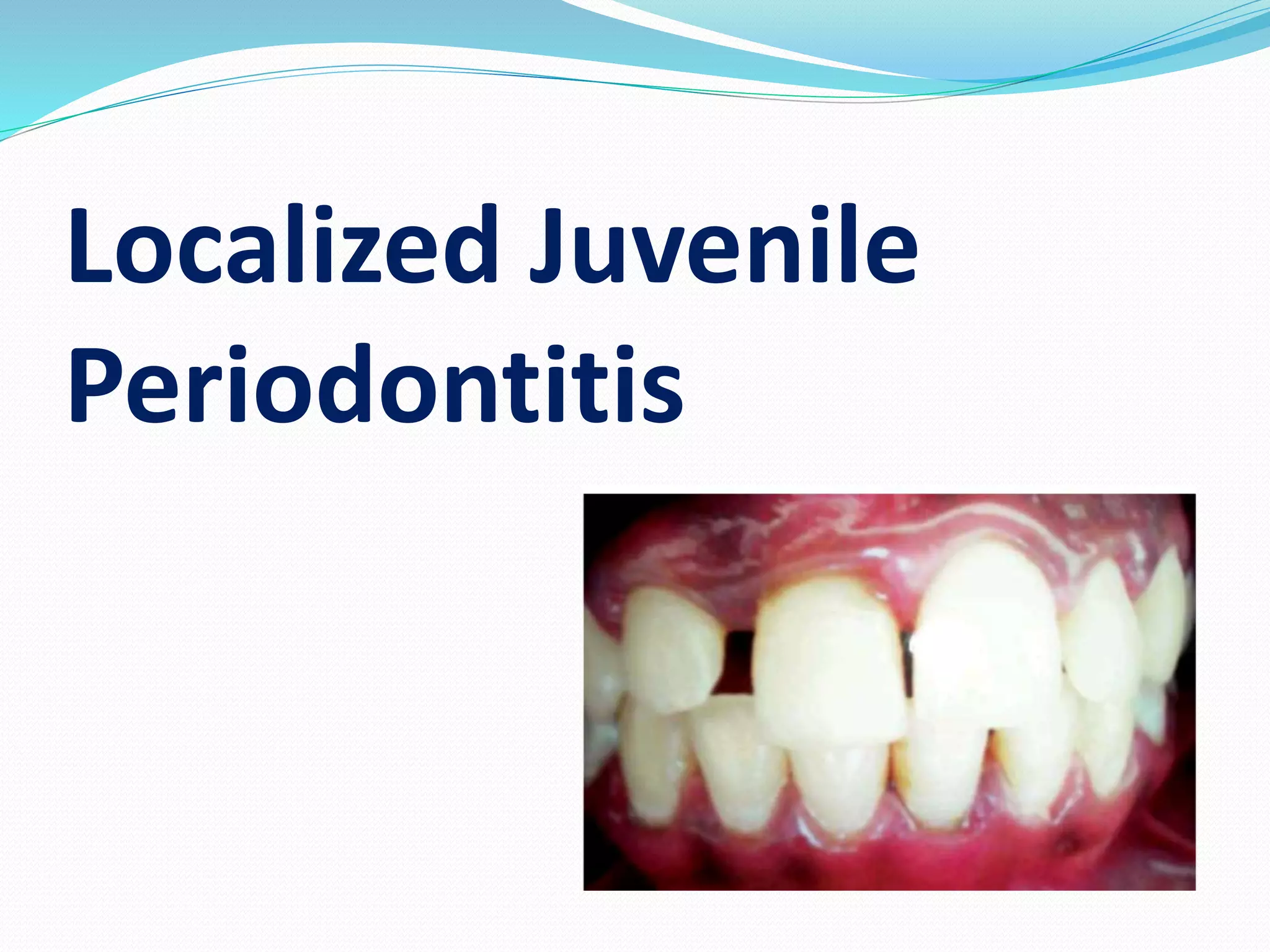 Juvenile Periodontitis | PPTX