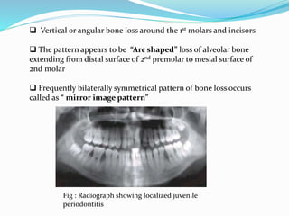 Juvenile Periodontitis | PPTX | Dental Health | Diseases and Conditions