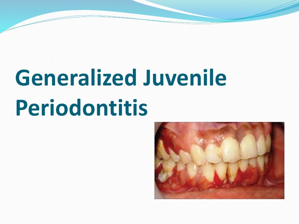Juvenile Periodontitis