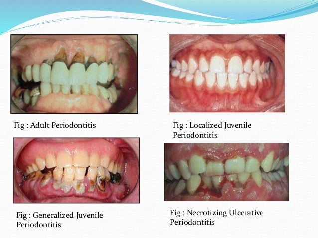Juvenile Periodontitis