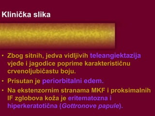 Juvenilni dermatomiozitis | PPSX