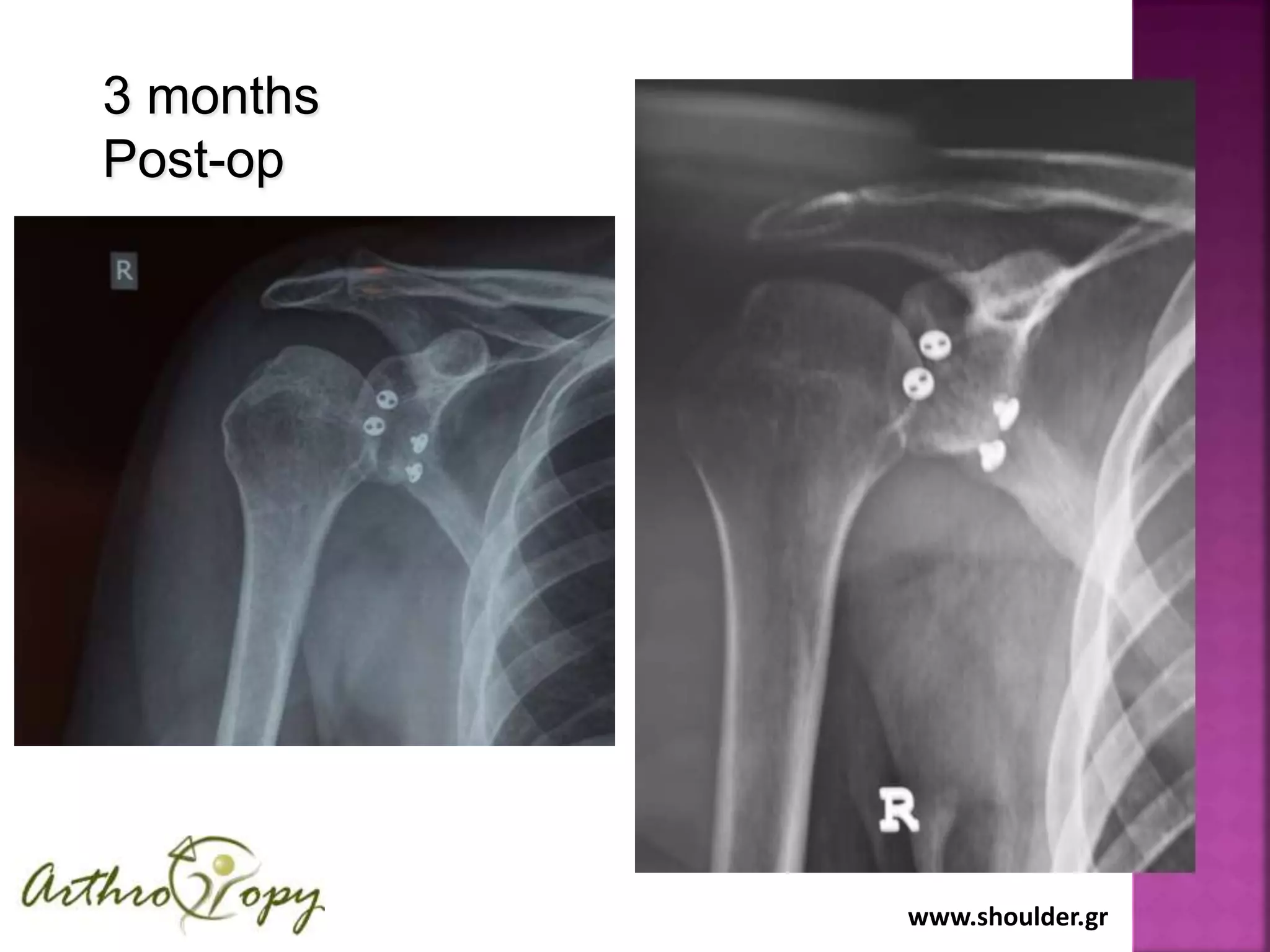 Traumatic shoulder dislocation 2017 kat | PPT