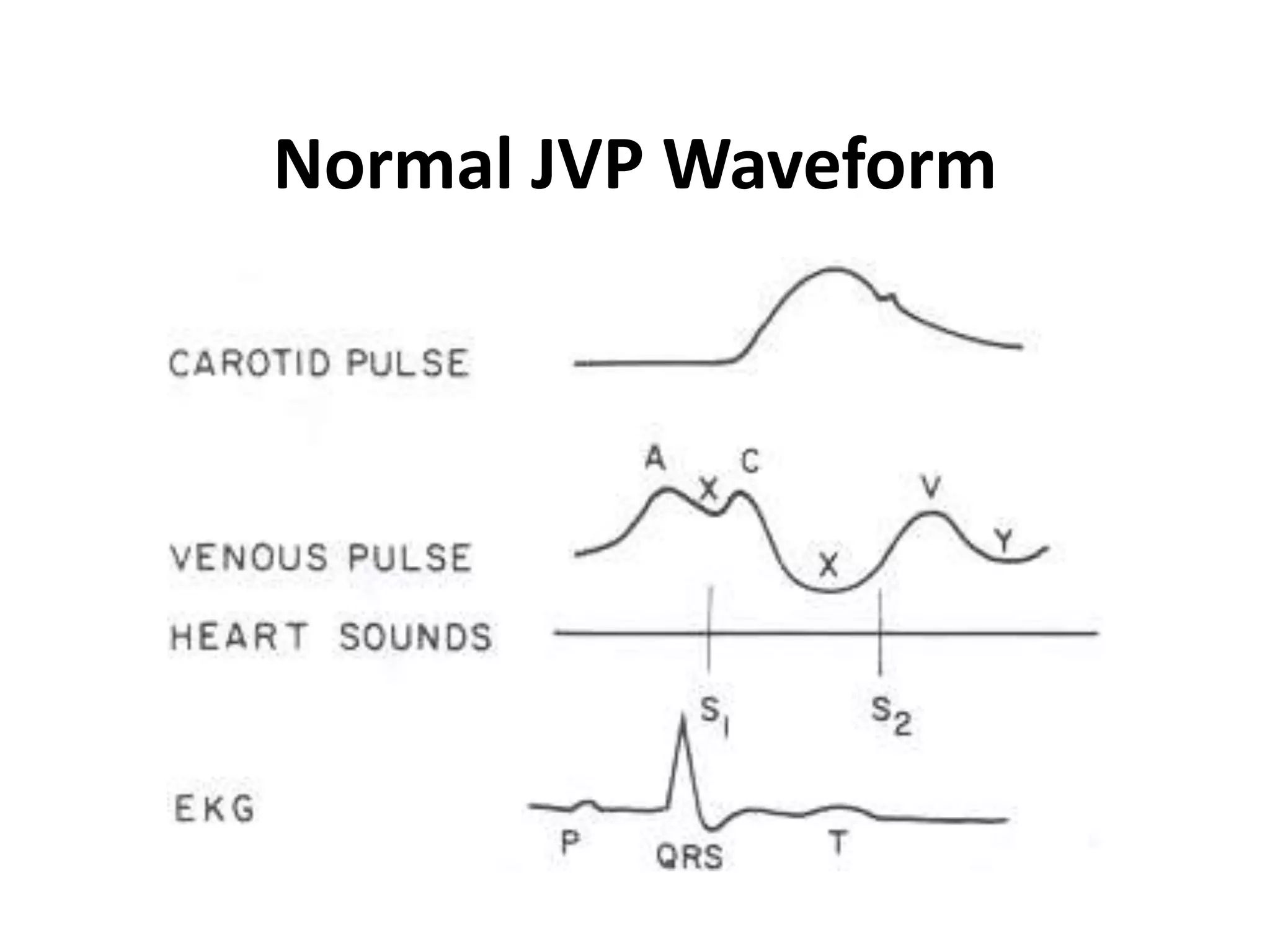 JVP AND WAVEFORMS.ppt
