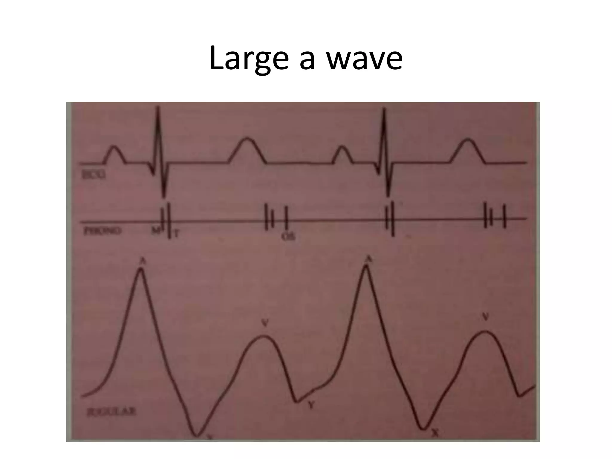 JVP AND WAVEFORMS.ppt
