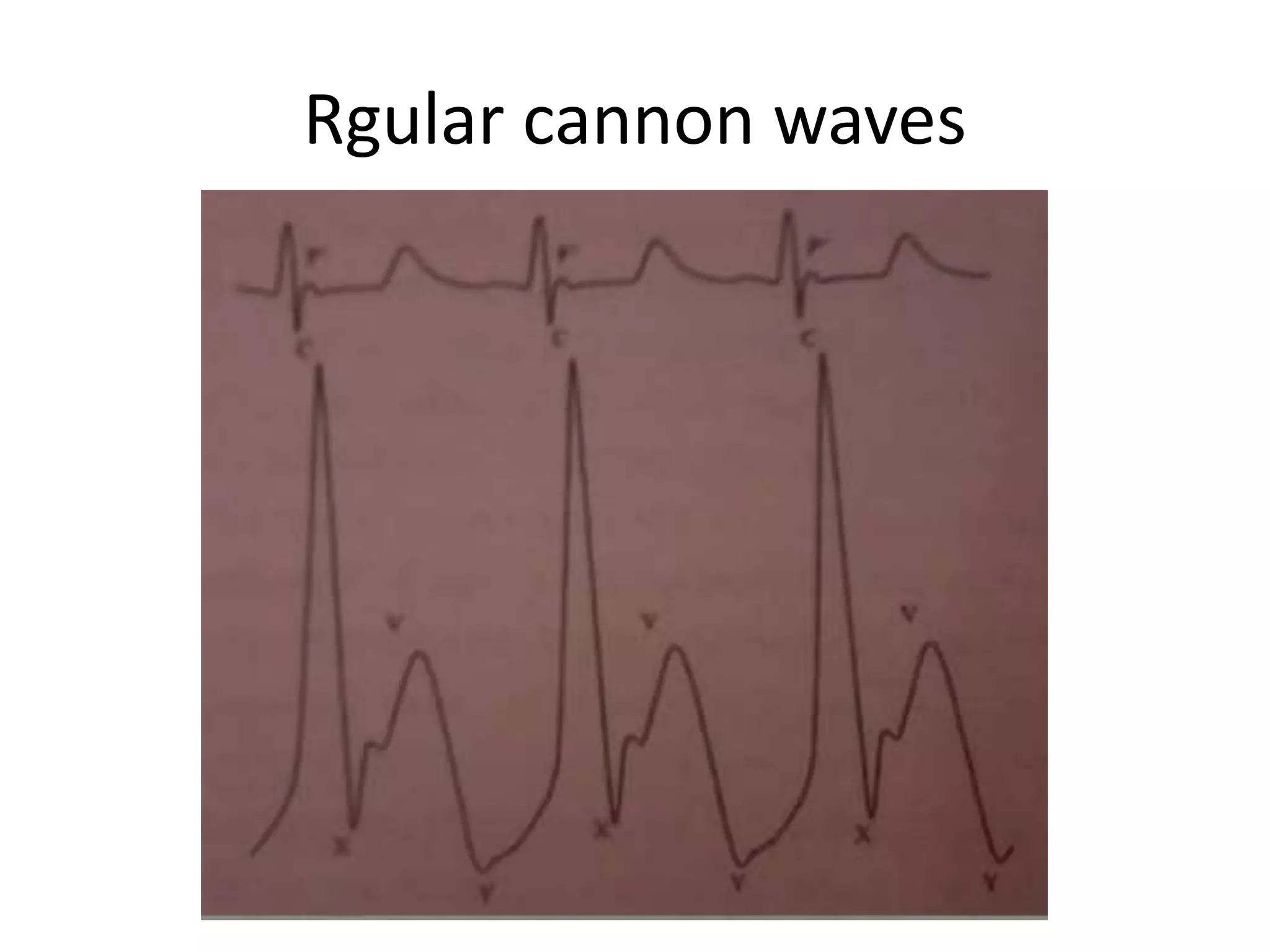 Jvp And Waveforms Ppt