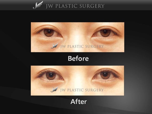 JW Plastic Surgery before and after pictures, Korea plastic surgery | PPT