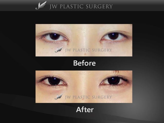 JW Plastic Surgery before and after pictures, Korea plastic surgery | PPT