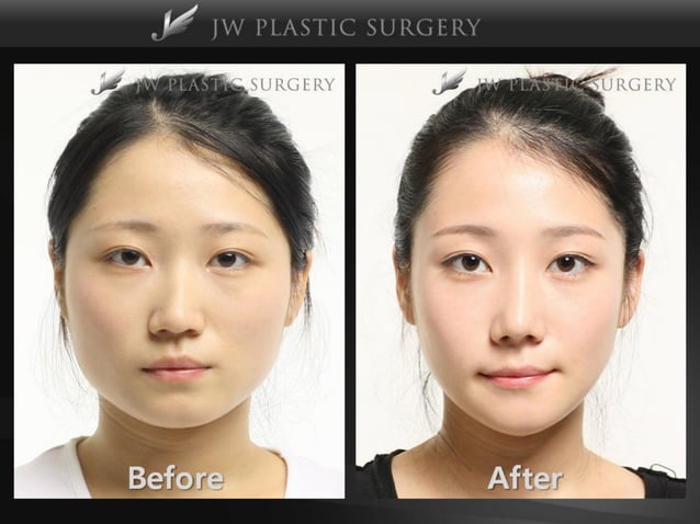 JW Plastic Surgery before and after pictures, Korea plastic surgery | PPT