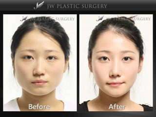 Korean Plastic Surgery Gone Wrong