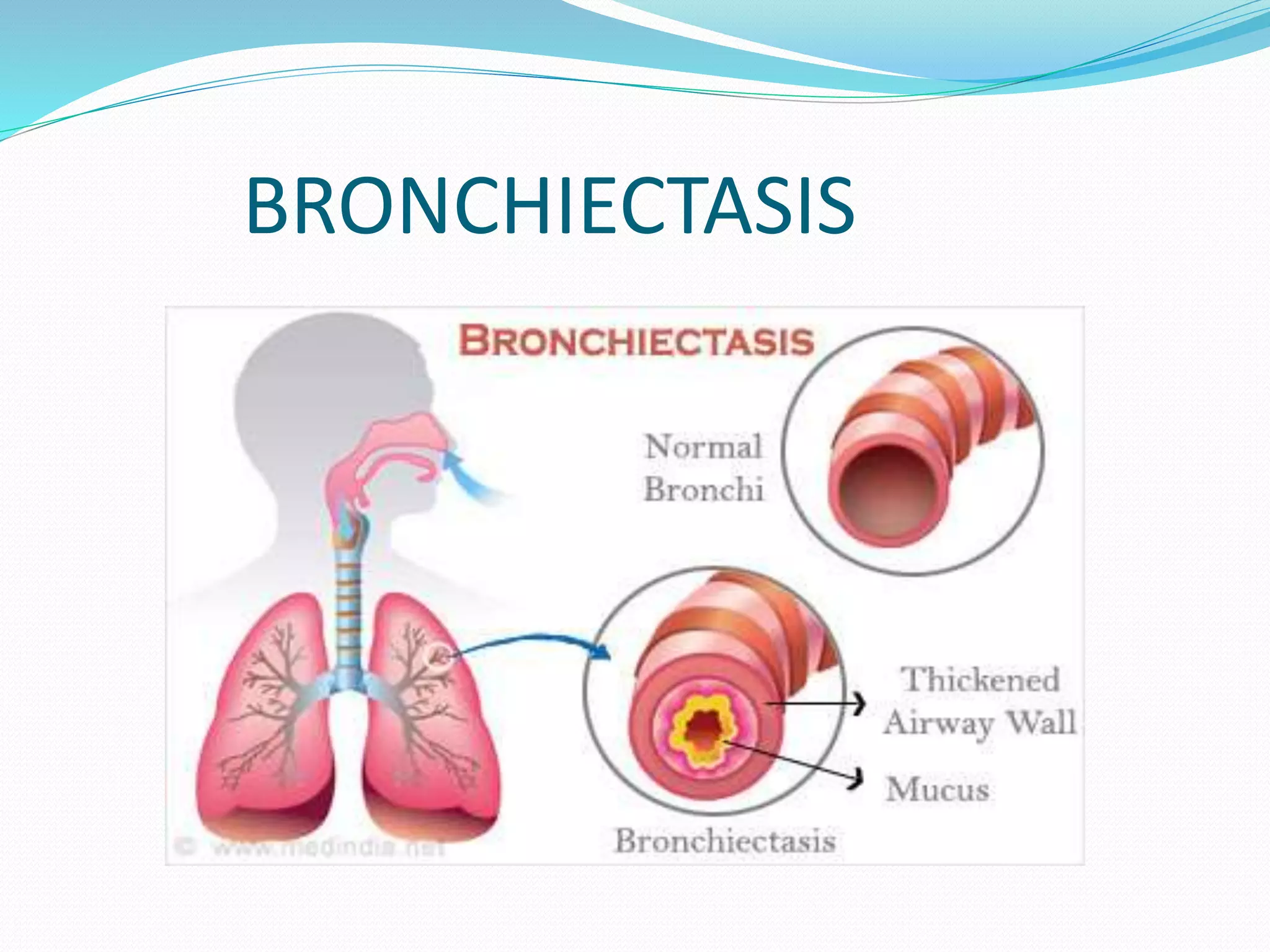 Atelectasis ppt Nikhil | PPTX