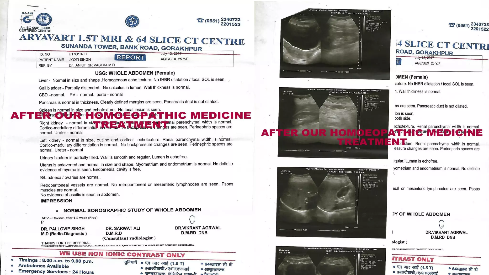 PCOD (Poly Cystic Ovarian Disease) B/L Ovary & Our Homoeopathic ...