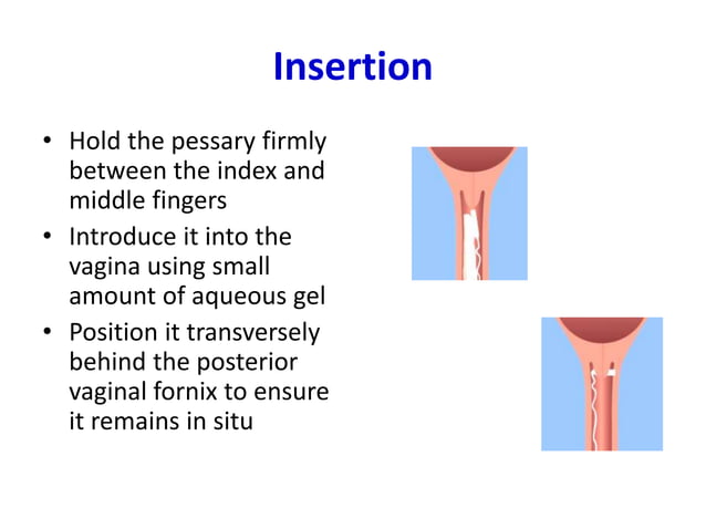 Novel Formulation of Prostaglandins for Induction of Labour ...